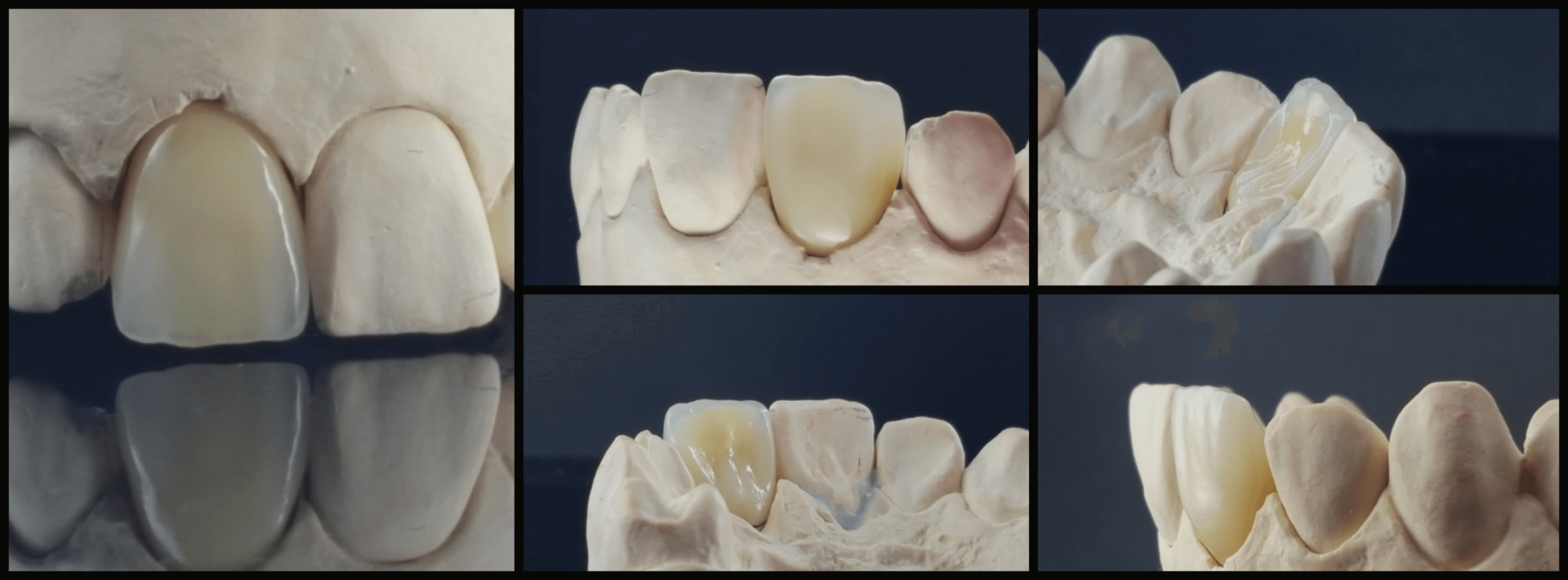 Fogpótlás, fogkoronák és fogászati hidak | Windrose Dental