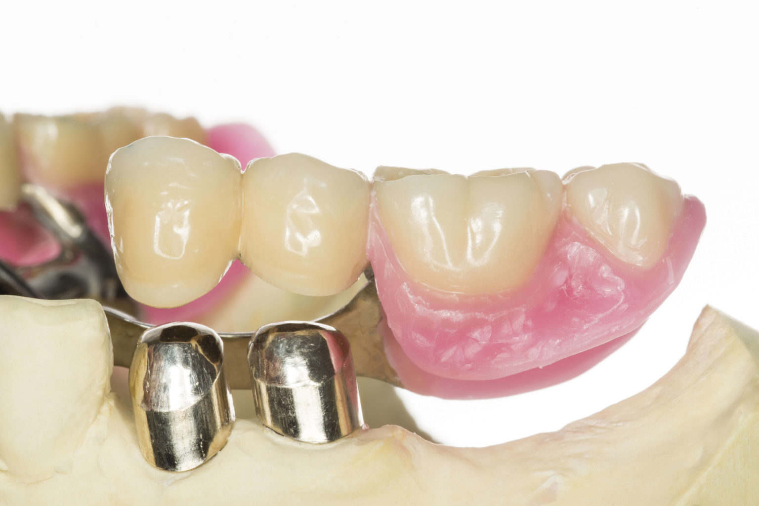 Teleskopprothese - Kombinierter Zahnersatz | Windrose Dental